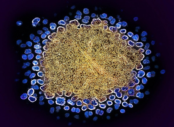 U.S. clinical trials begin for twice-yearly HIV prevention injection ...