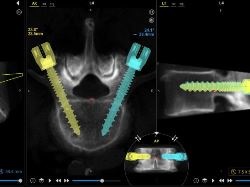 Study Compares Robotic-Assisted to Augmented Reality Spine Surgery ...